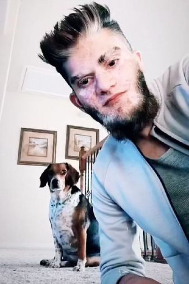 Мужчину, которого путают дедушкой, рассказал о своем редком заболевании ...