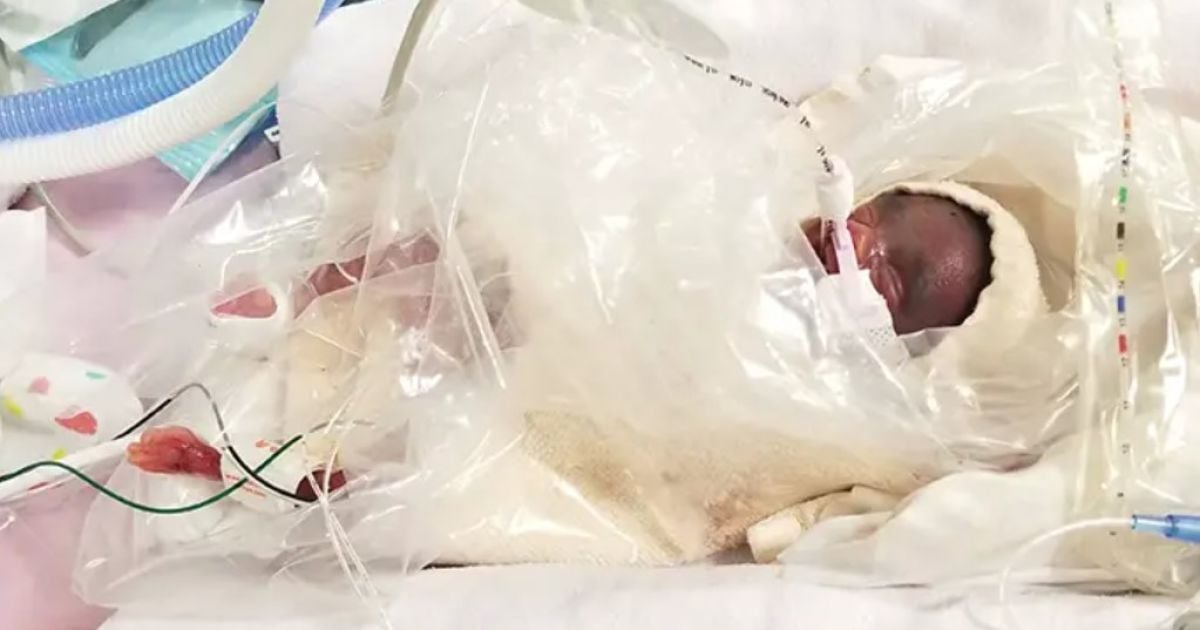 Найбільш недоношені близнюки у світі: Адія та Адріал здивували медиків ...